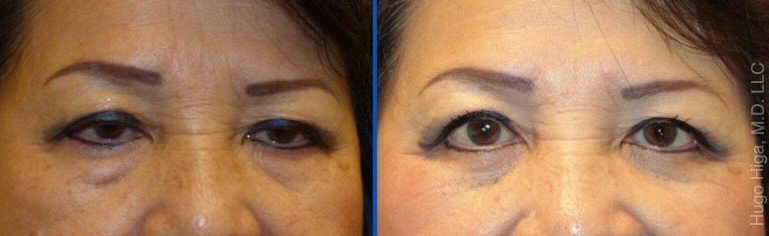 Before and After Eyelids – Hugo Higa, MD – Eyelid and Facial Surgery