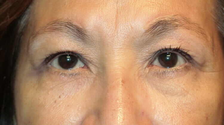 Eyebrows – Hugo Higa, MD – Eyelid and Facial Surgery