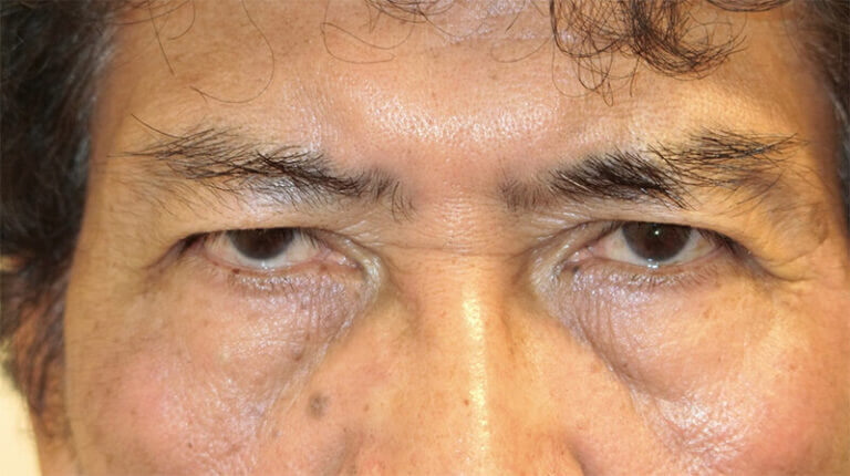 Eyebrows - Hugo Higa, MD - Eyelid and Facial Surgery