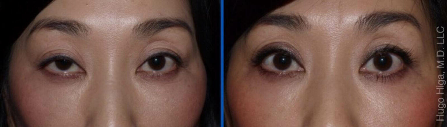 Before and After Eyelids – Hugo Higa, MD – Eyelid and Facial Surgery