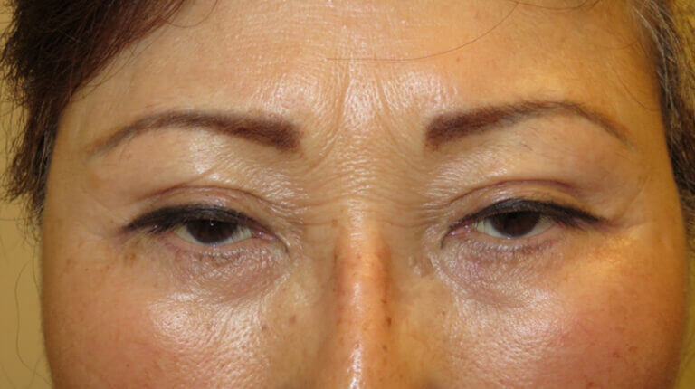 Asian Eyelids - Hugo Higa, MD - Eyelid and Facial Surgery
