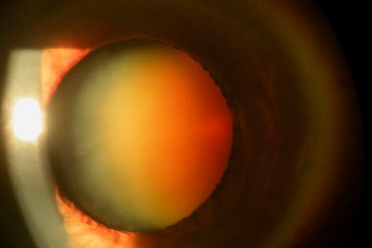 Cataracts - Hugo Higa, MD - Eyelid and Facial Surgery