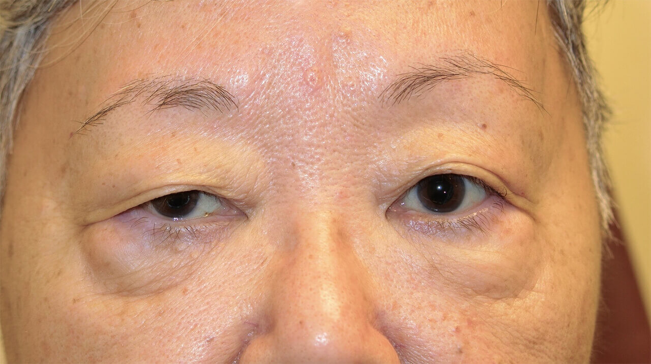 Droopy Eyelids Hugo Higa MD Eyelid And Facial Surgery Droopy Eyelids Hugo Higa MD Eyelid And Facial Surgery